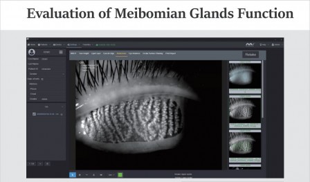 Carleton Optical - Mediworks Dry Eye Diagnostic System