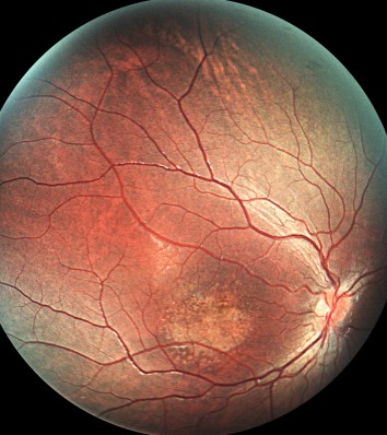 Carleton Optical - NeoLight Phoenix ICON Paediatric Retinal Camera